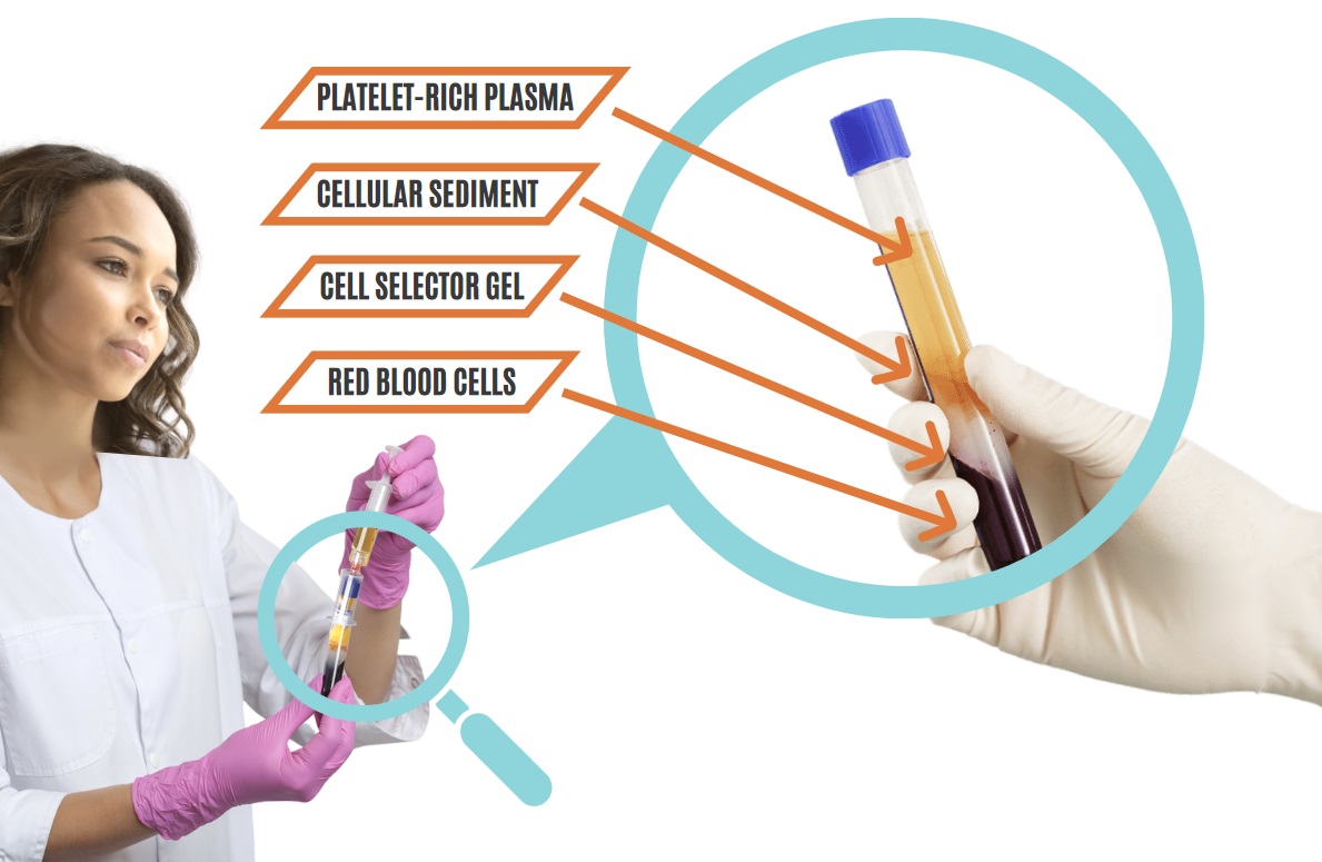 Platelet-Rich Plasma Therapy - Niche Hand Surgery & Orthopedics